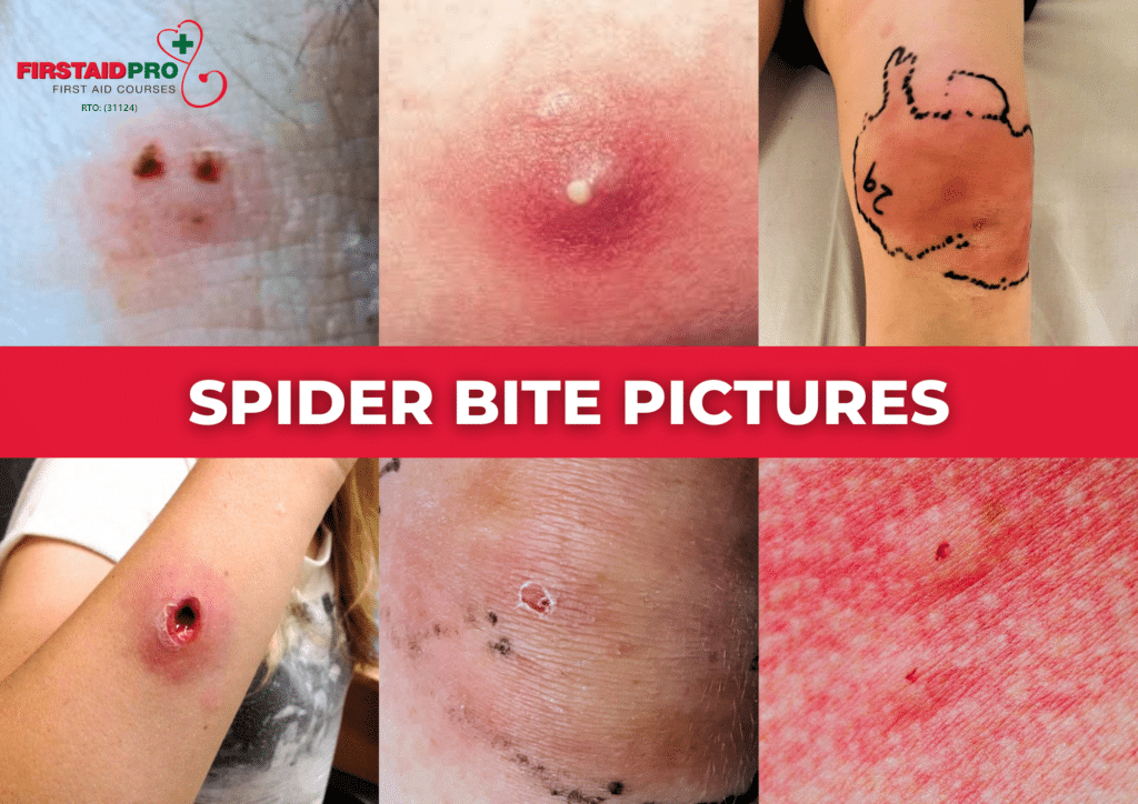 Spider Bite On Thigh Spider Bite On Thigh