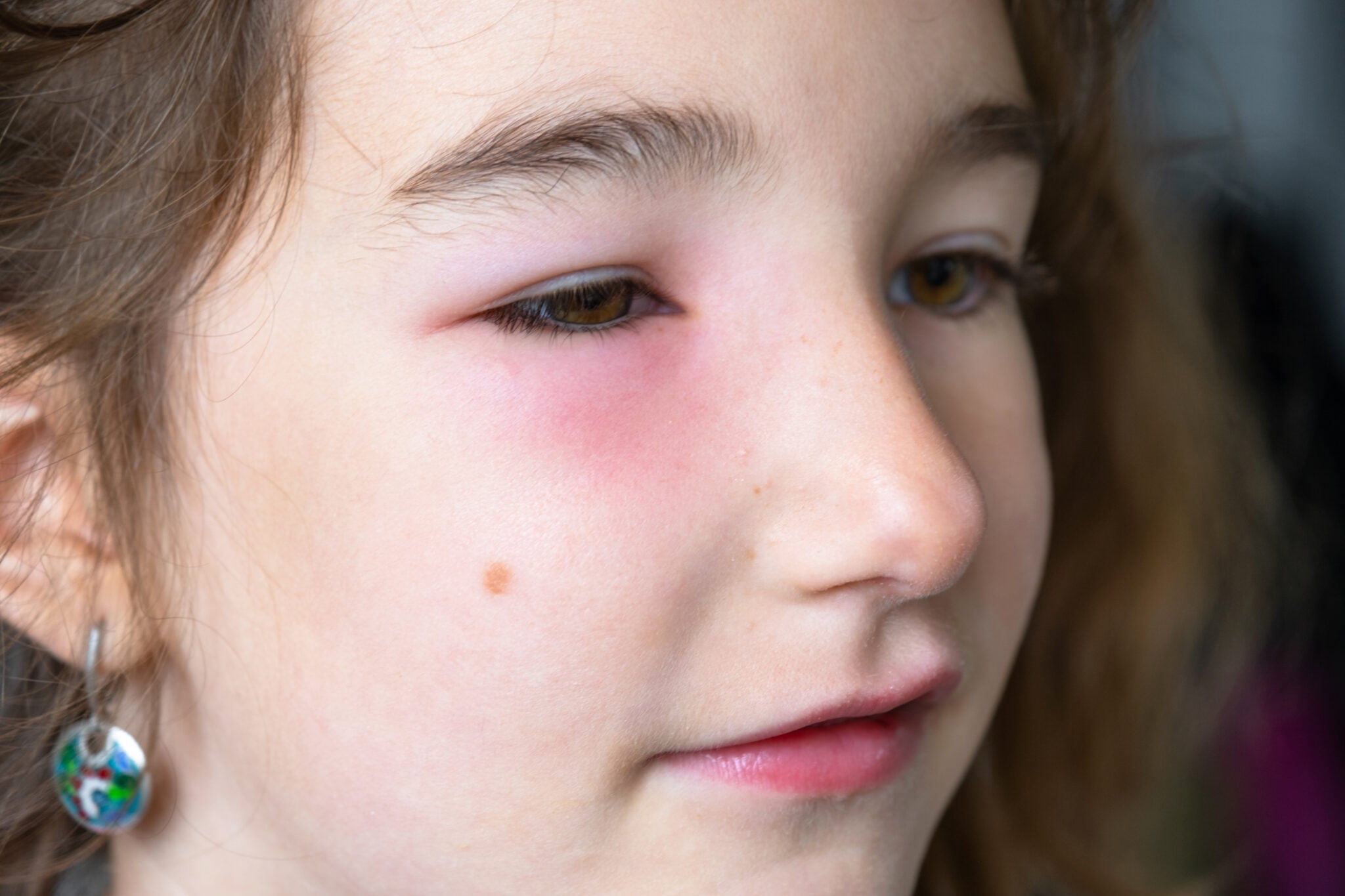 Kids' Eye Injury First Aid Tips for Effective Treatment