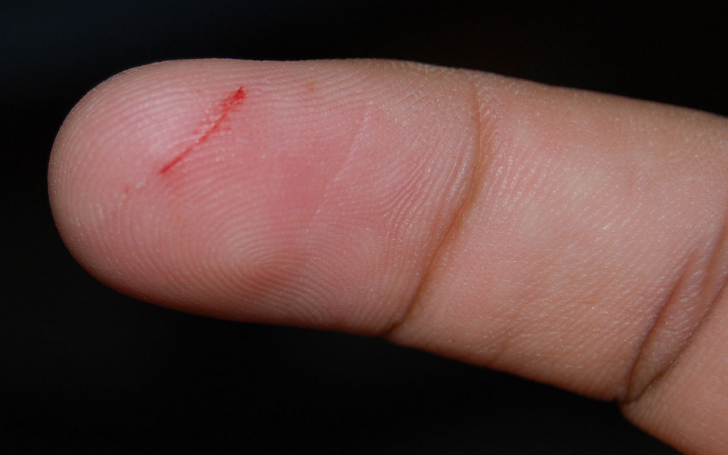 Prevent Infection in Cuts: Top First Aid Tips for Healing