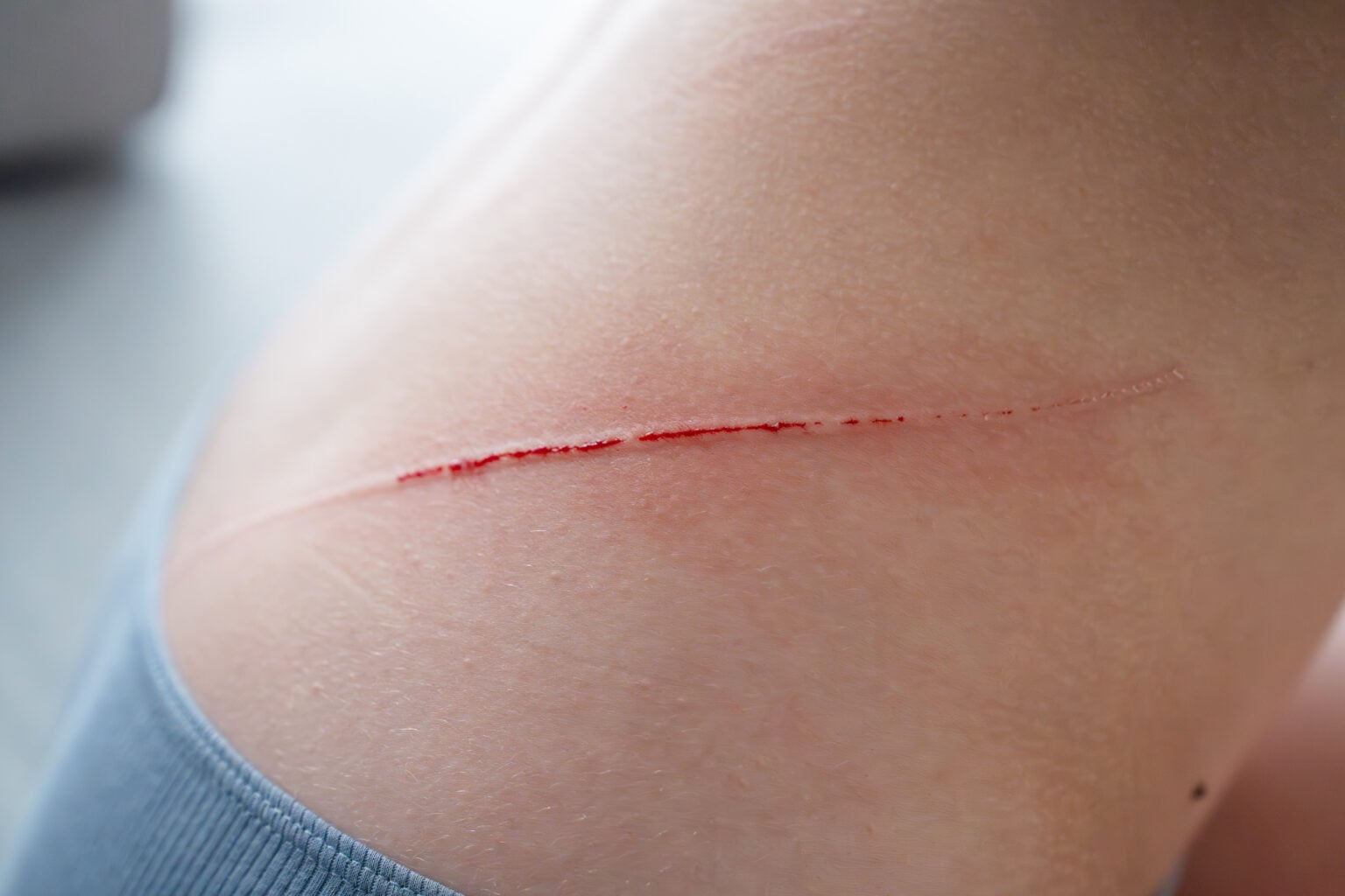 Wound Infection Prevention: 7 Tips for Safety