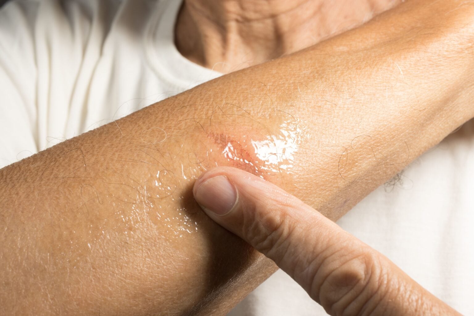 What Are The Best Ointments For Burns?