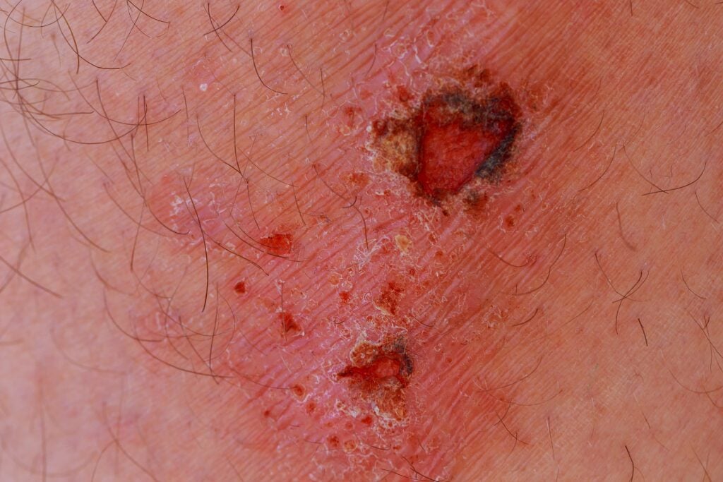 How to Clean an Open Wound: Essential First Aid Knowledge
