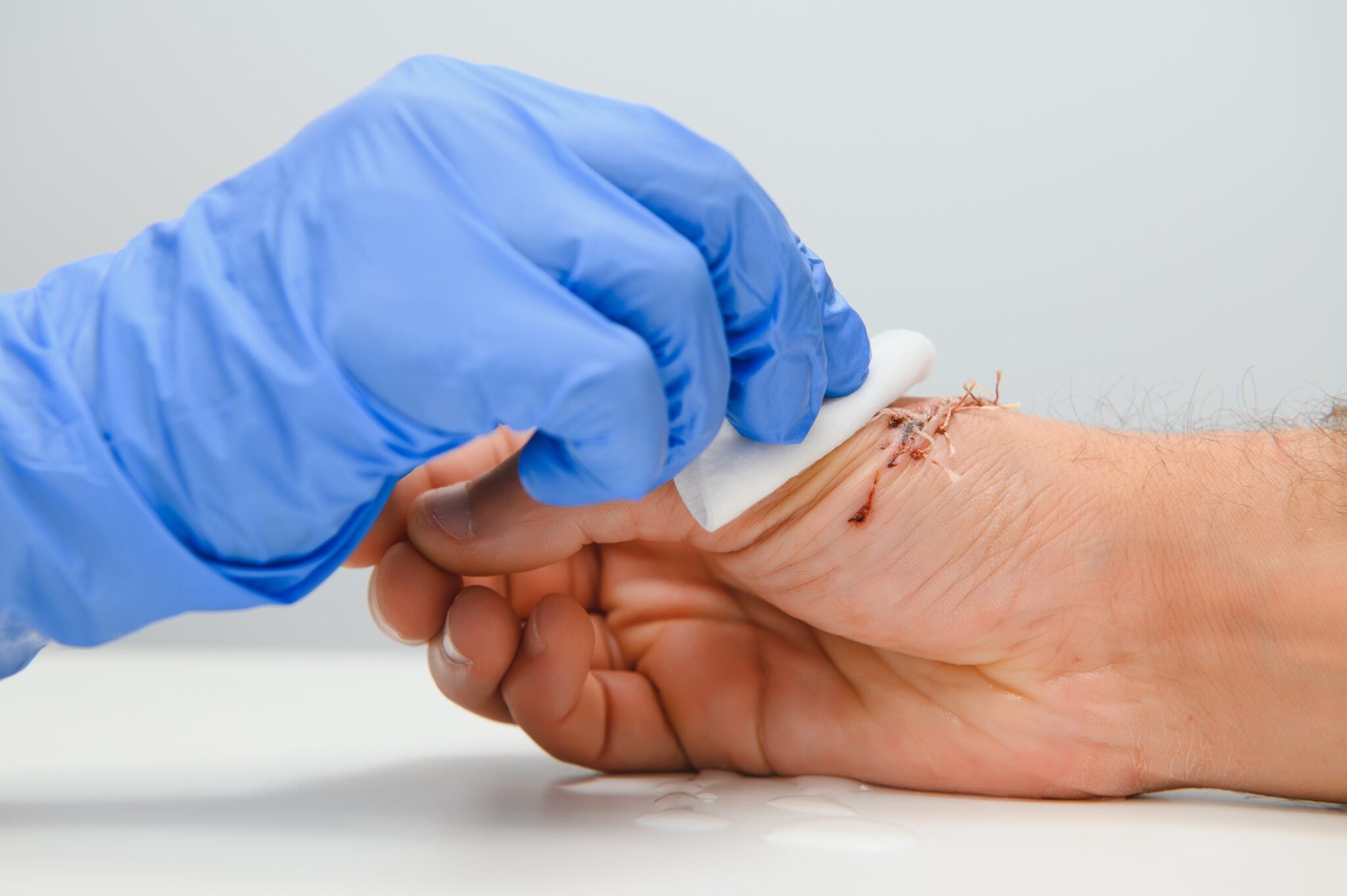 Cleaning a Wound Safely: Top First Aid Techniques