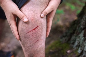 Deep Wound: First Aid For Treating and Dressing An Injury