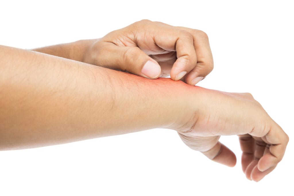 First Aid Steps for Allergic Reactions and Anaphylaxis