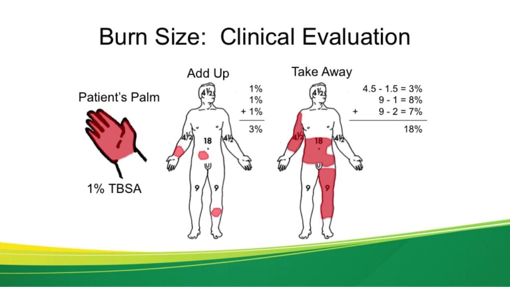 Treating Second-Degree Burns: A Step-by-Step Guide