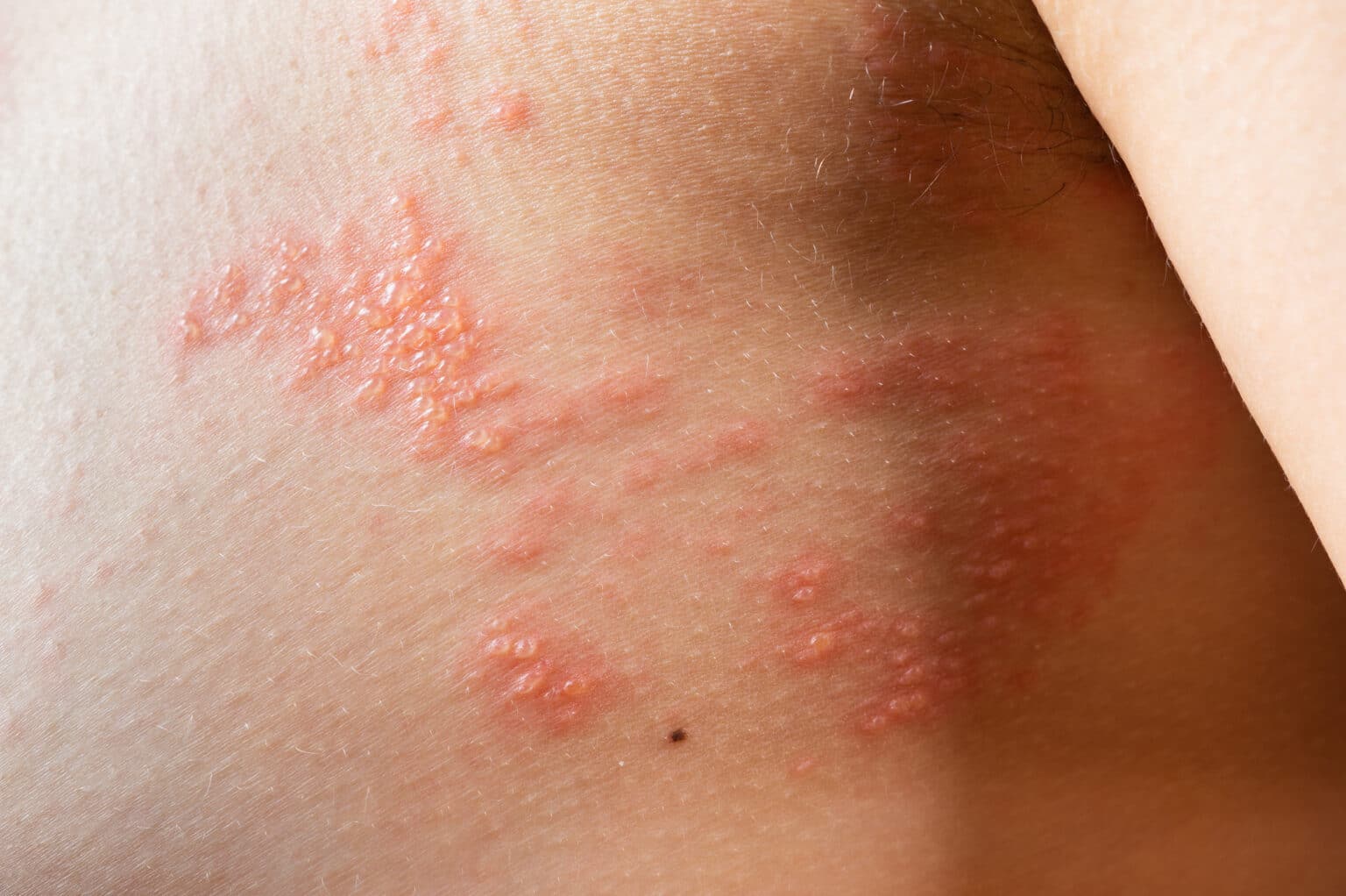 Shingles (Herpes Zoster): A Complete Guide to Symptoms, Treatment and Prevention - FirstAidPro