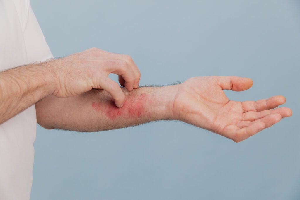 Insect Bites and Stings: How to Provide First Aid Treatment