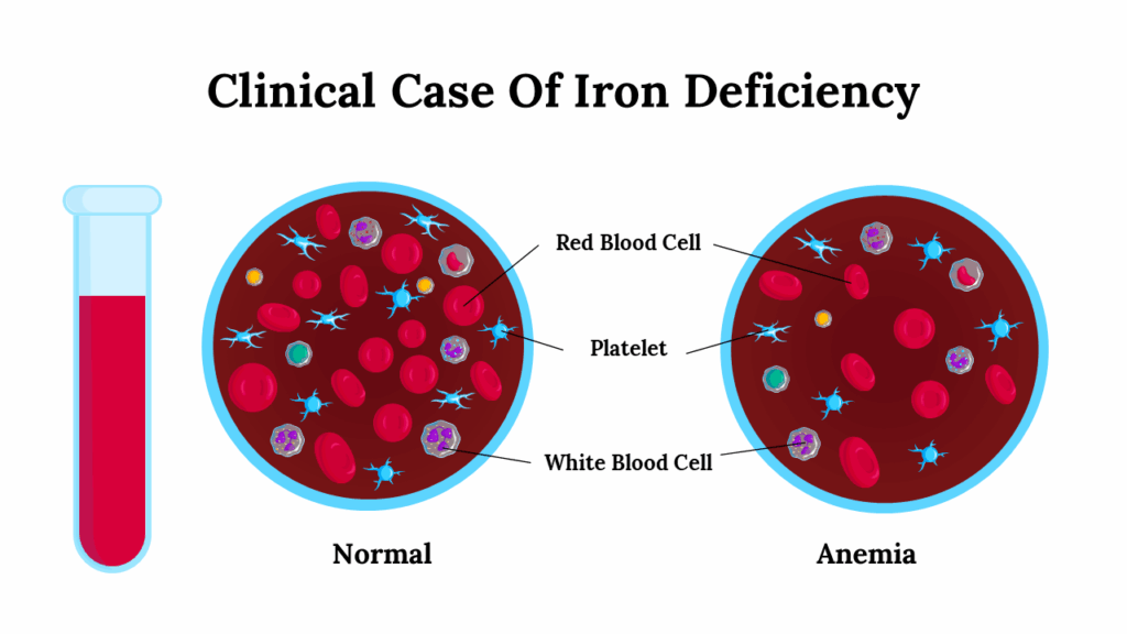 Iron Deficiency & Iron Deficiency Anaemia: Symptoms, Causes, Tests ...