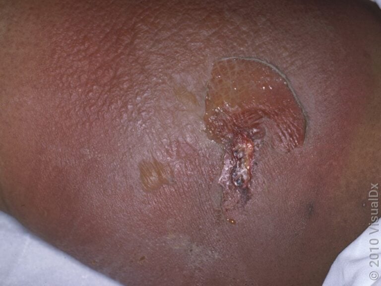 White Tail Spider – Identification, Bite Symptoms & Treatment - FirstAidPro