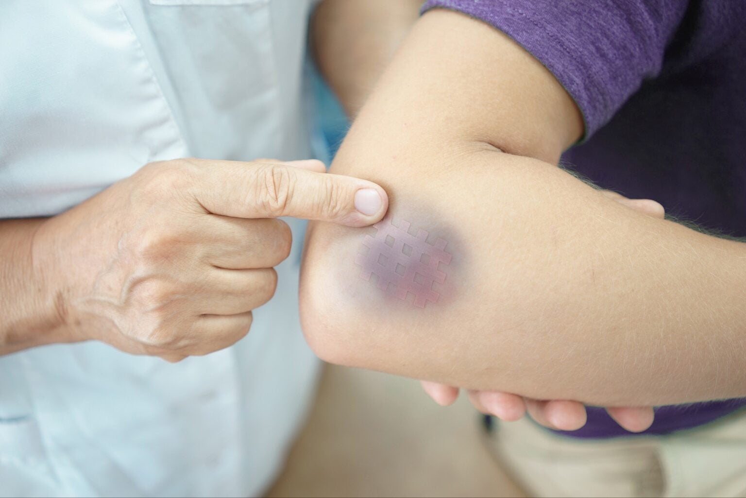 How To Treat A Contusion Wound – Everything You Need to Know - FirstAidPro
